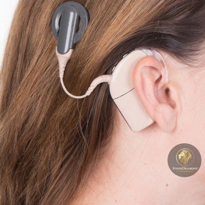 How to register cochlear implant? - Stone Okamont